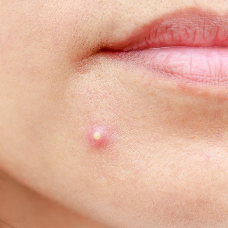 Pimples with white heads - why do I get them? And how do I get rid of ...